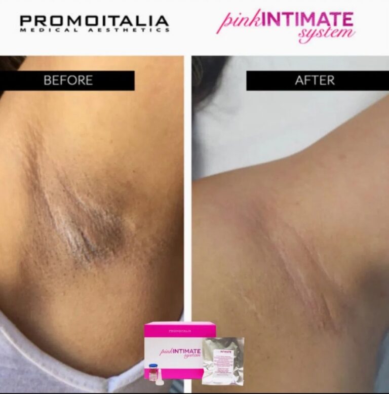 Italian Pink System for Intimate Whitening | Bionix Clinic