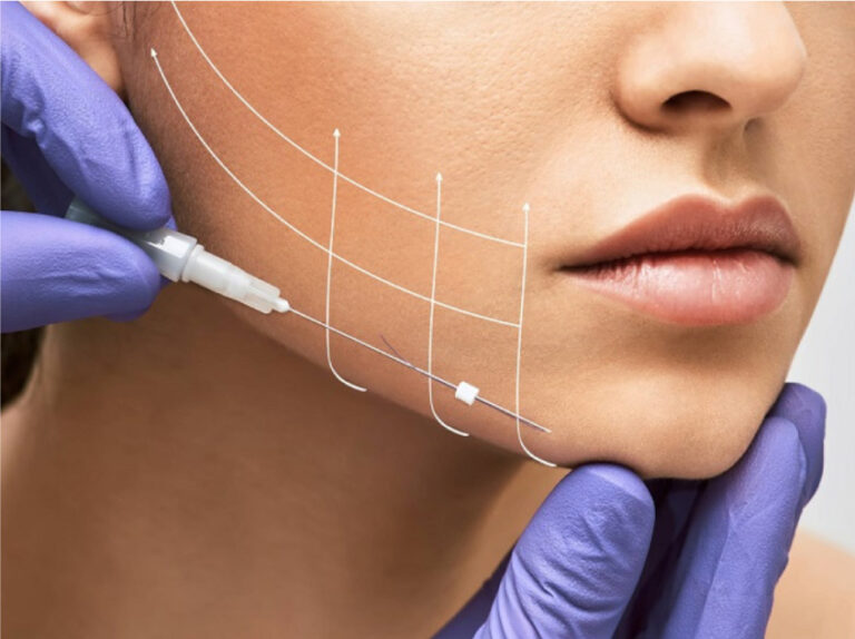 Thread Lift in Dubai Non-Surgical Skin Lifting Jumeirah & Al Barsha